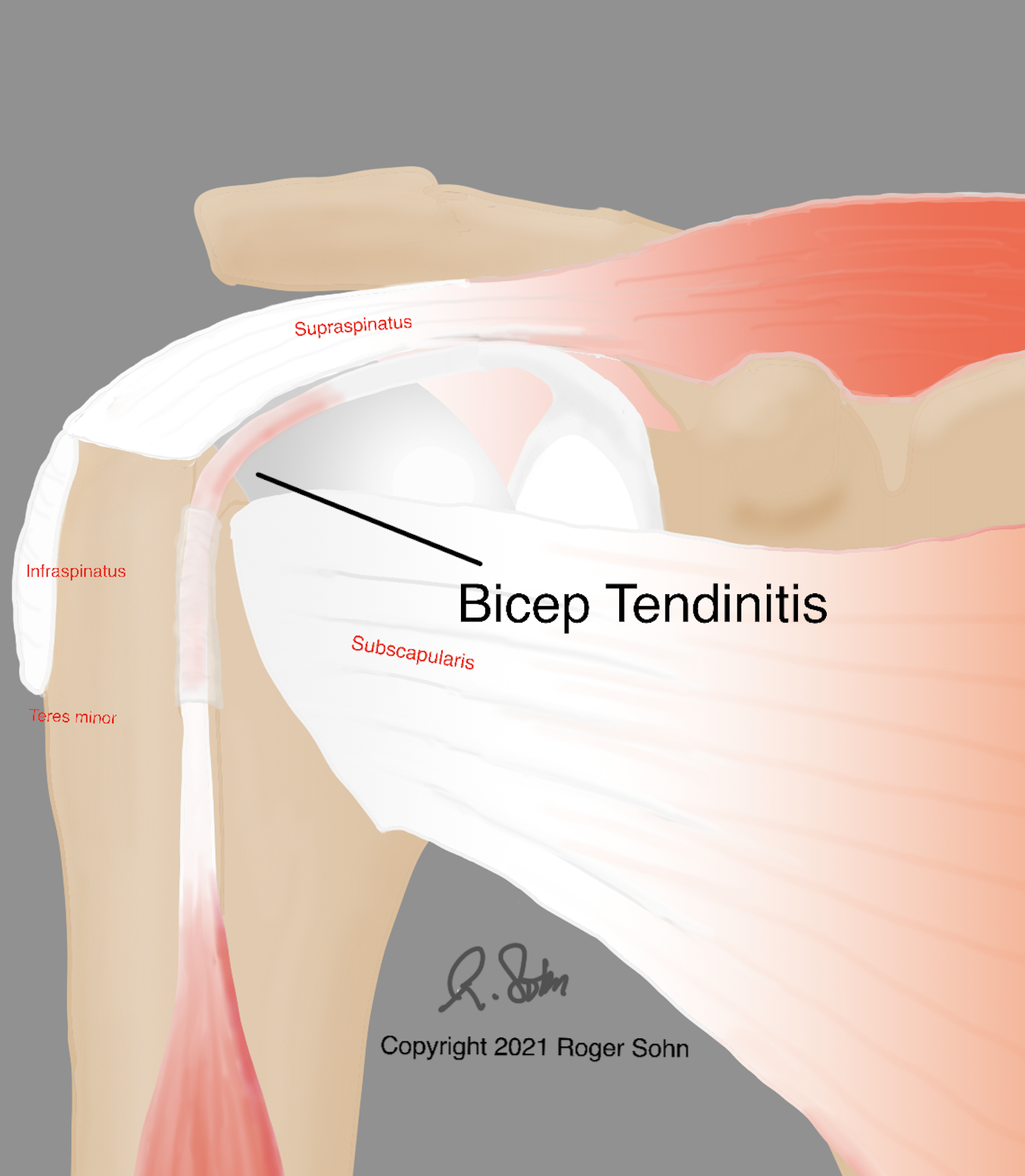 Bicep Tendinitis – Orthocare Health