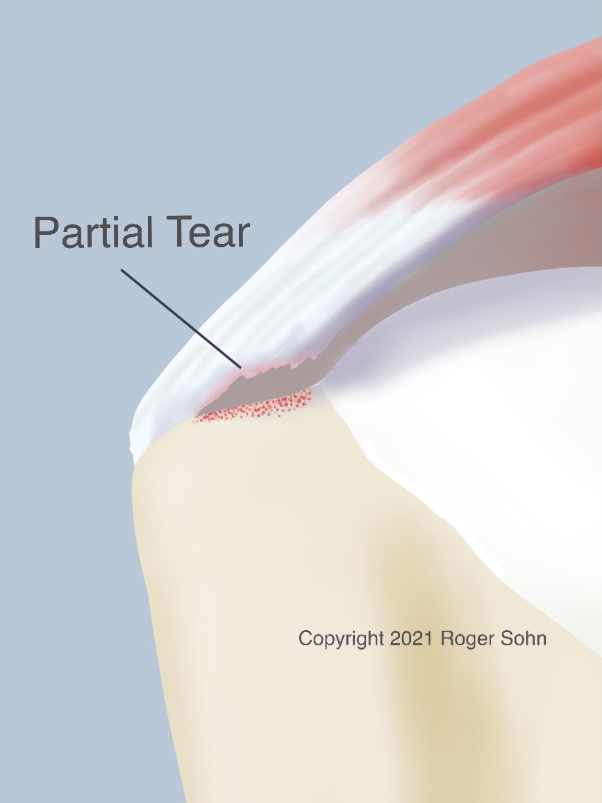 Rotator Cuff Tears – Orthocare Health